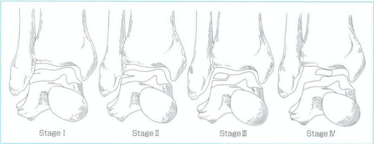OLT (osteochondral lesion of talus) | 整形外科診療所