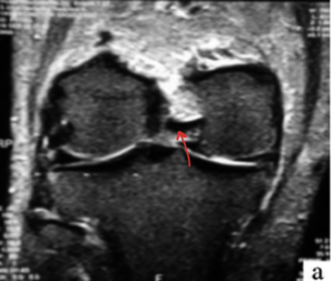 半月板縦断裂の特徴的な画像所見 | 整形外科診療所