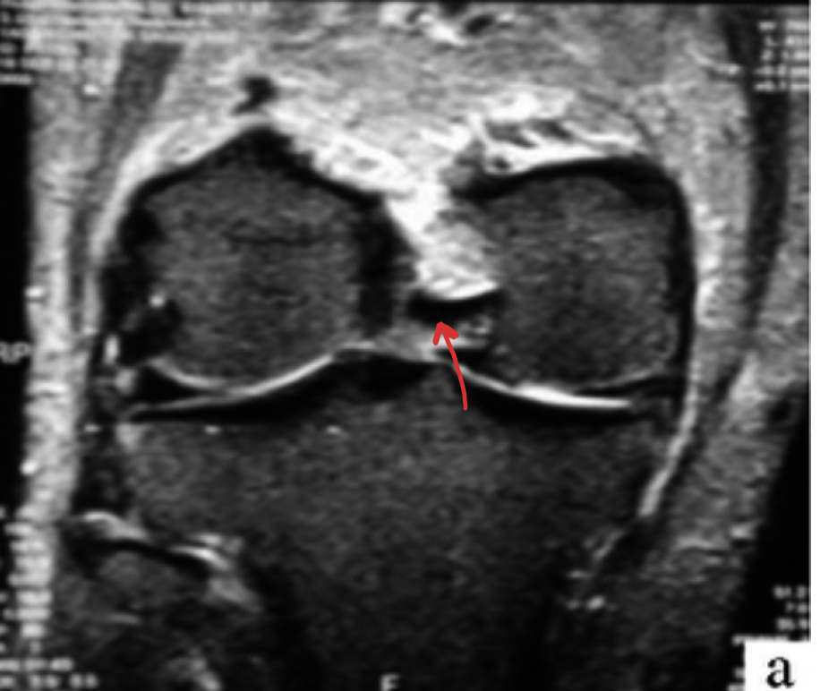 半月板縦断裂の特徴的な画像所見 | 整形外科診療所