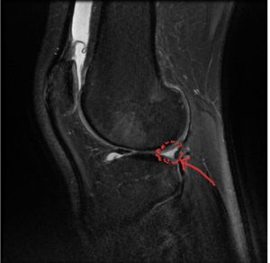 後根断裂（MMPRTなど） | 整形外科診療所