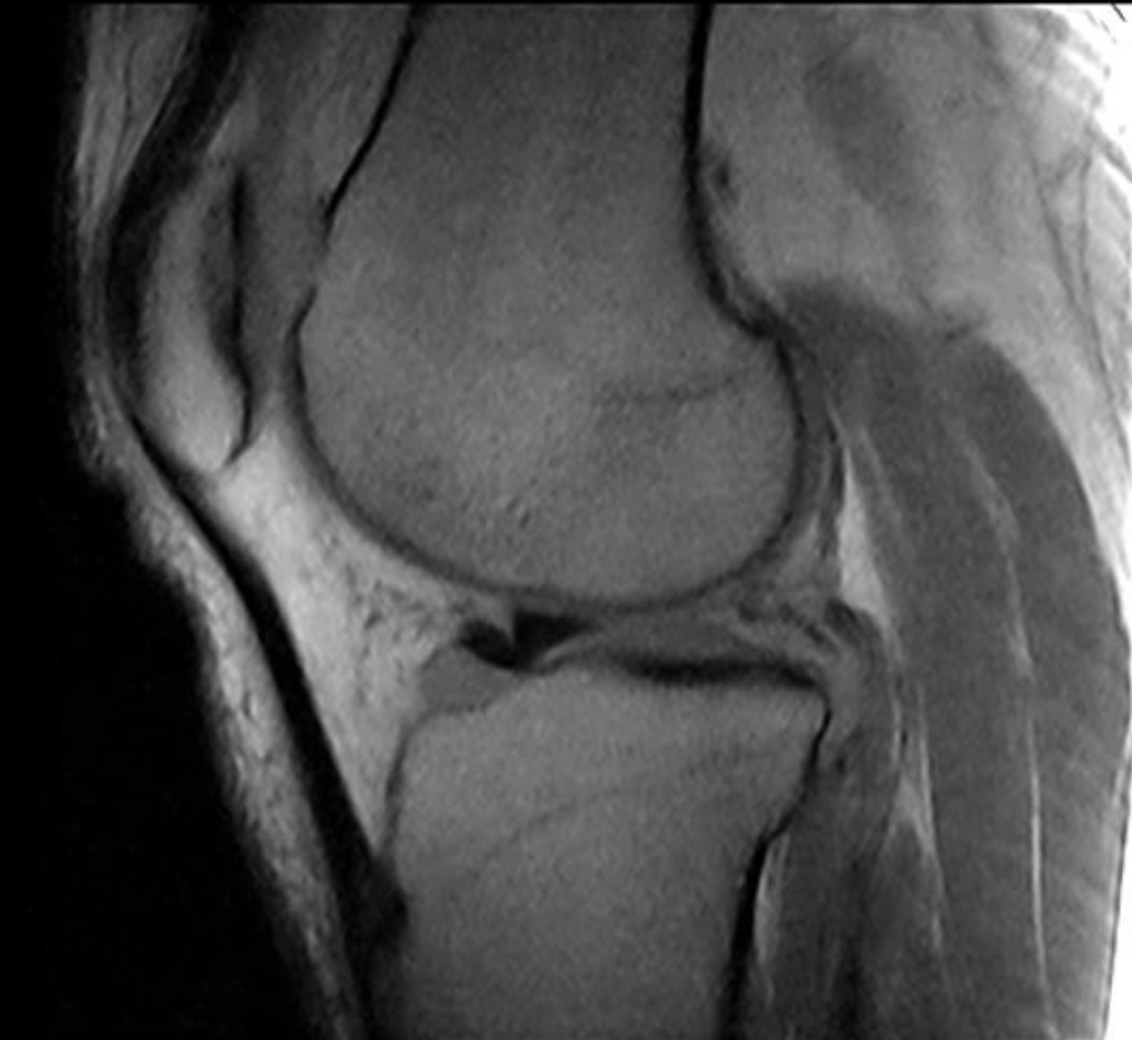 半月板縦断裂の特徴的な画像所見 | 整形外科診療所