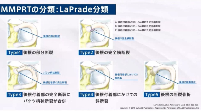 後根断裂（MMPRTなど） | 整形外科診療所