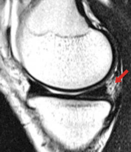 Ramp lesion | 整形外科診療所