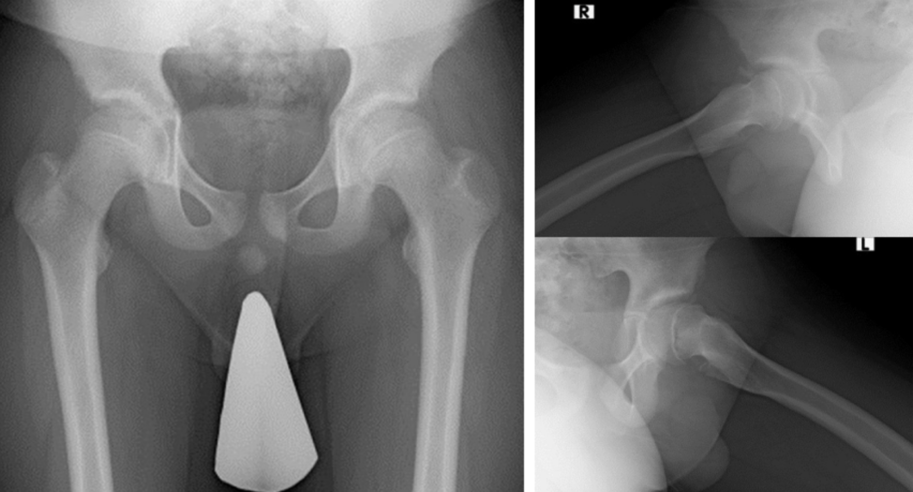 大腿骨頭すべり症 | 整形外科診療所
