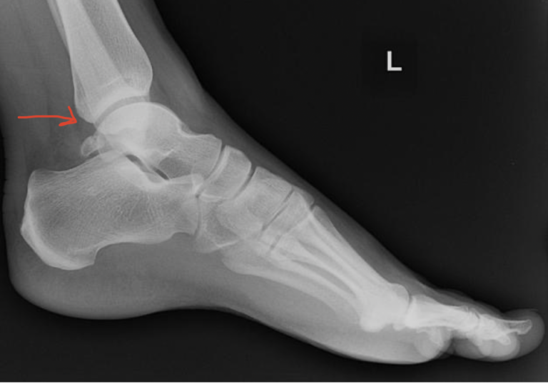 足部の種子骨 | 整形外科診療所